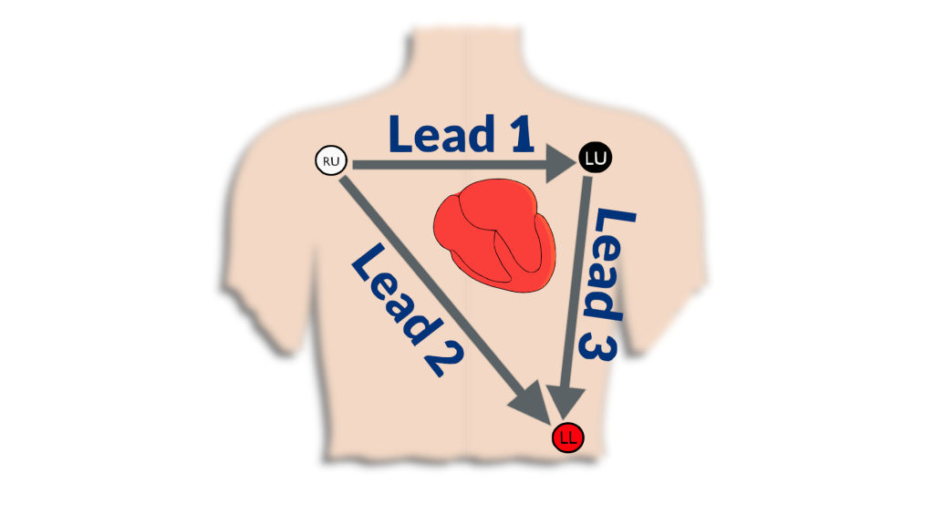 3-Lead ECG – Nursing Unraveled