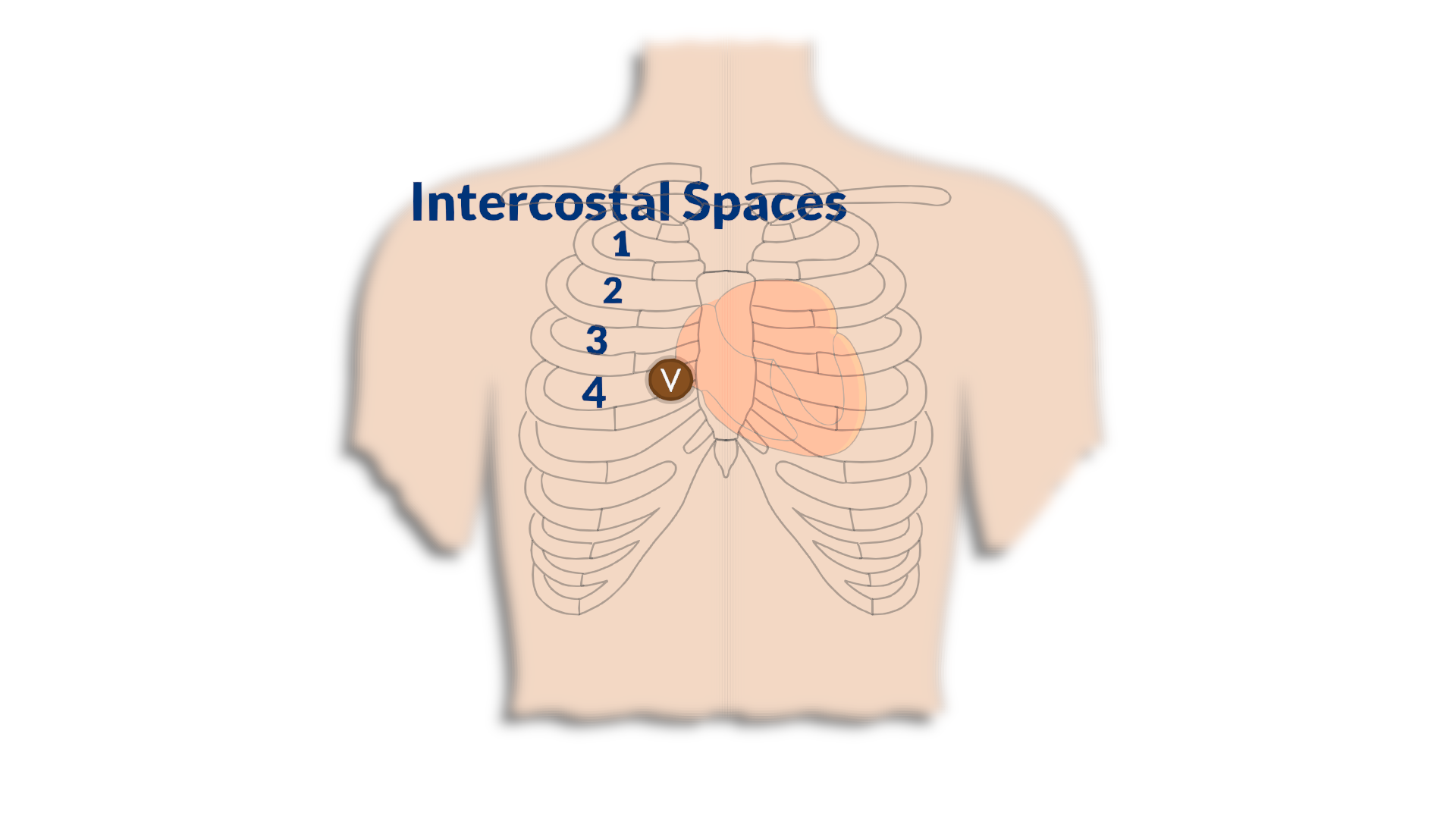 5-Lead ECG – Nursing Unraveled