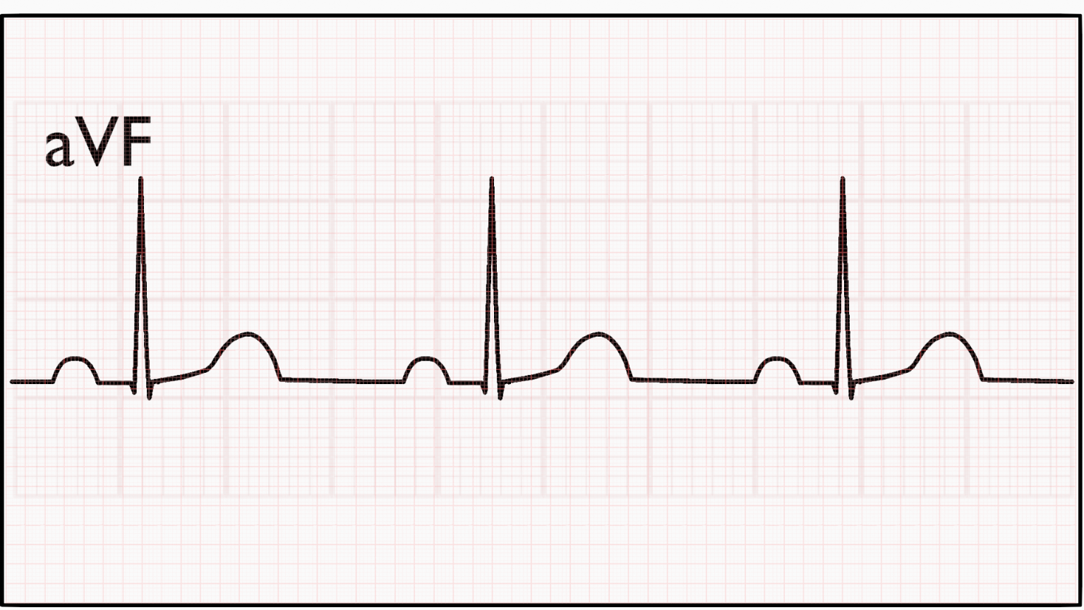 3-Lead ECG – Nursing Unraveled