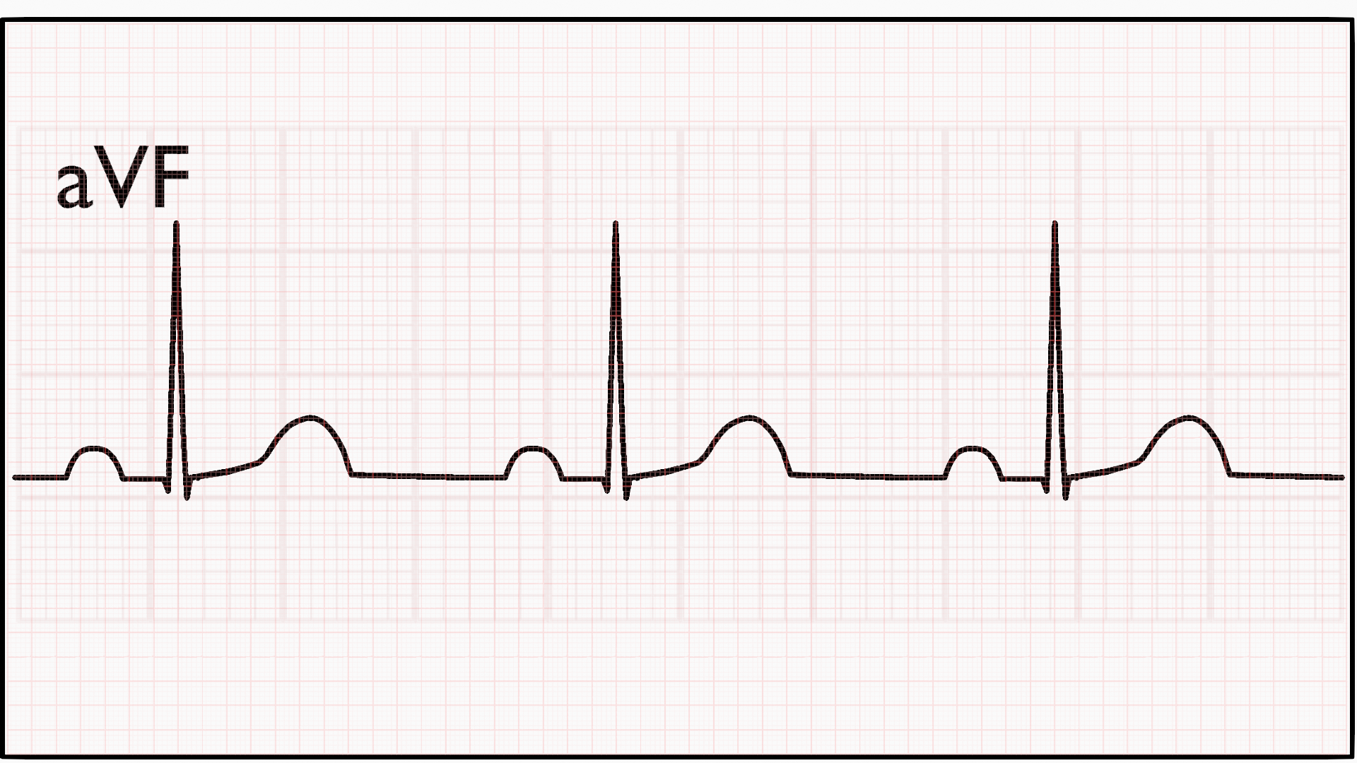 3-Lead ECG – Nursing Unraveled