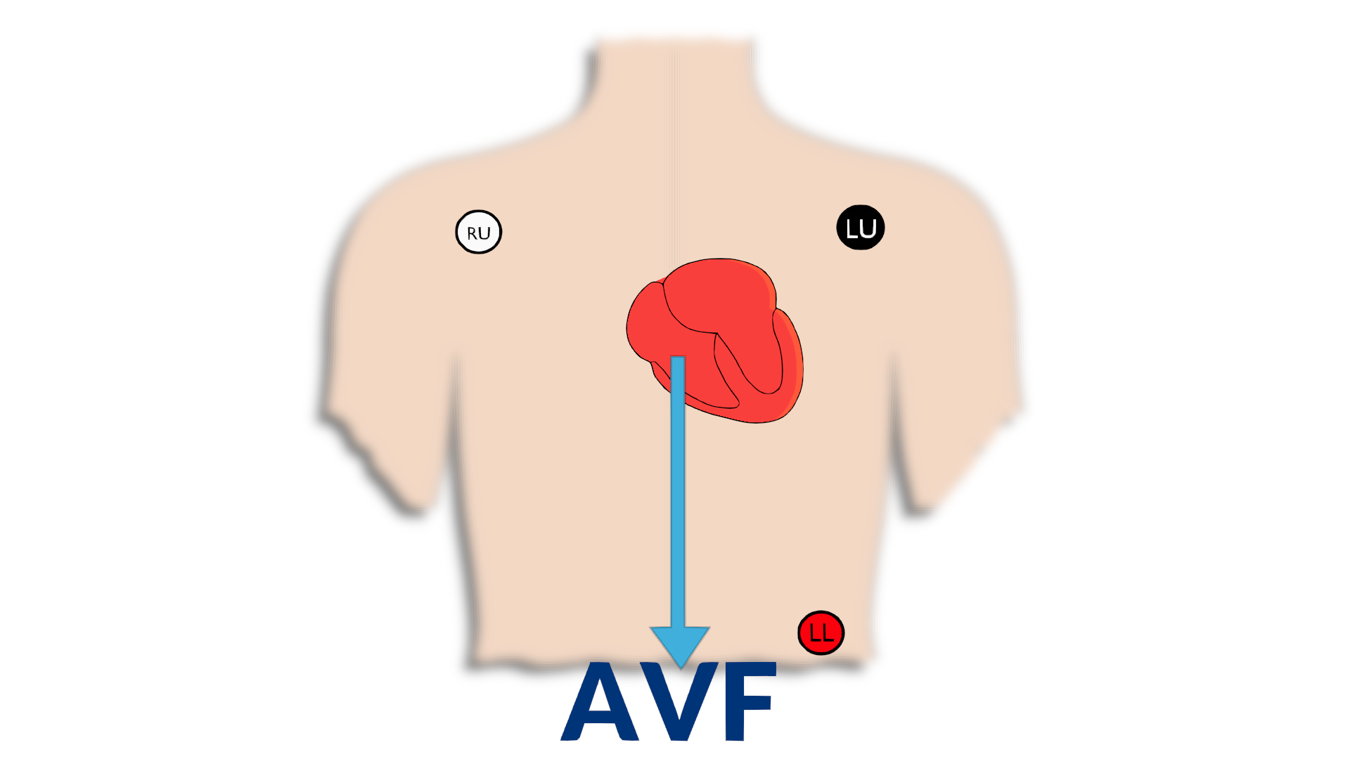 3-Lead ECG – Nursing Unraveled