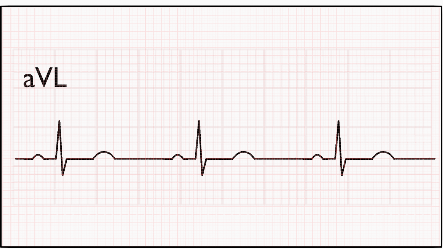 3-Lead ECG – Nursing Unraveled