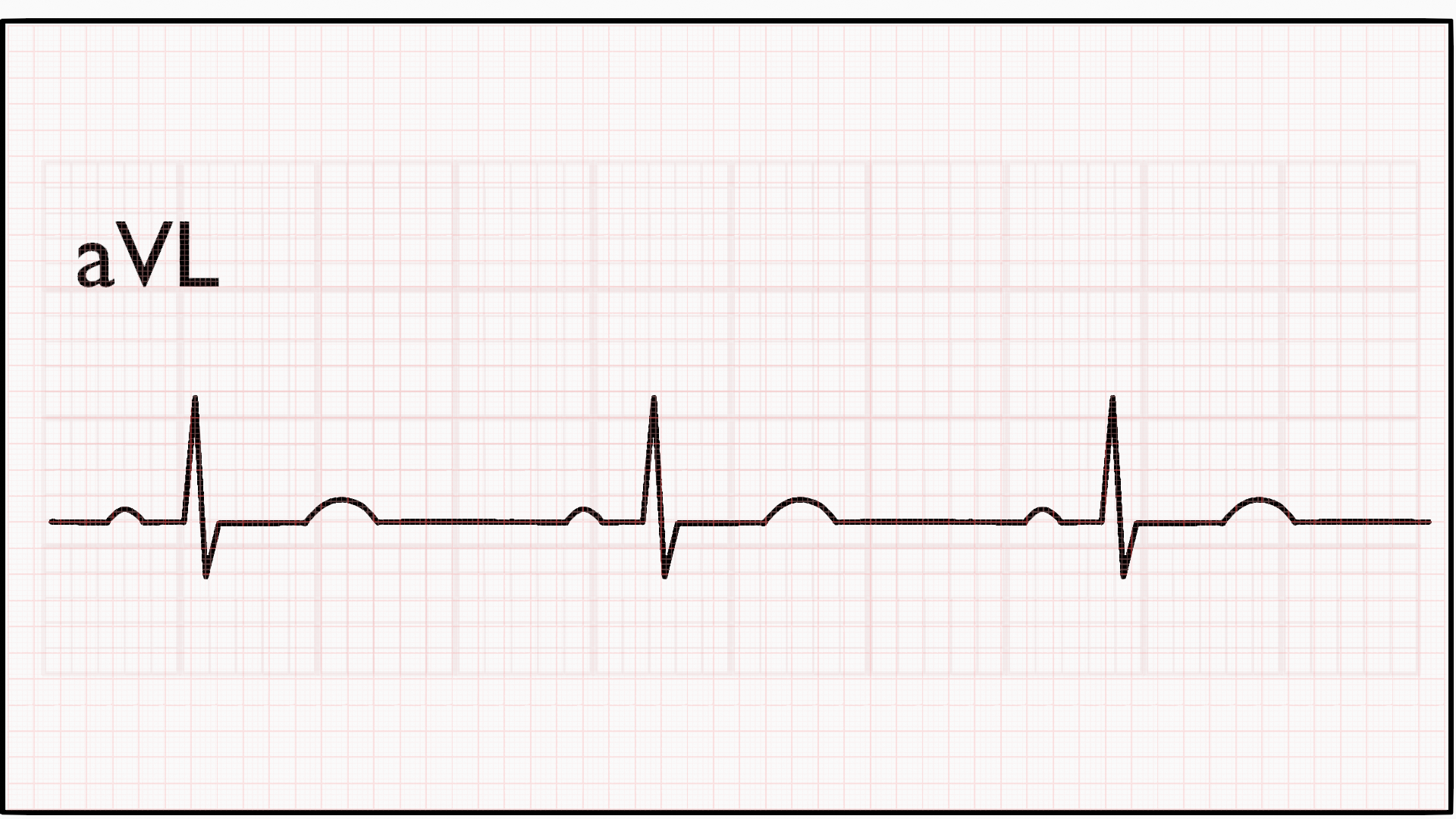 3-Lead ECG – Nursing Unraveled