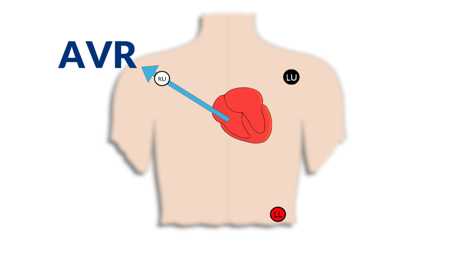 3-Lead ECG – Nursing Unraveled