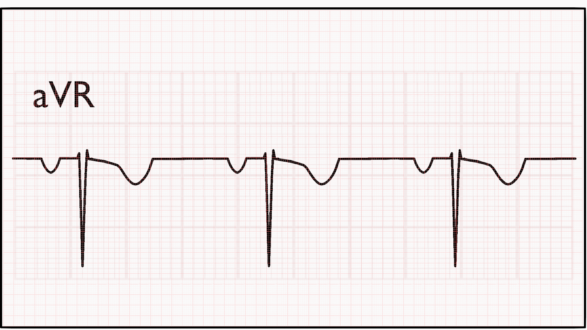 3-Lead ECG – Nursing Unraveled