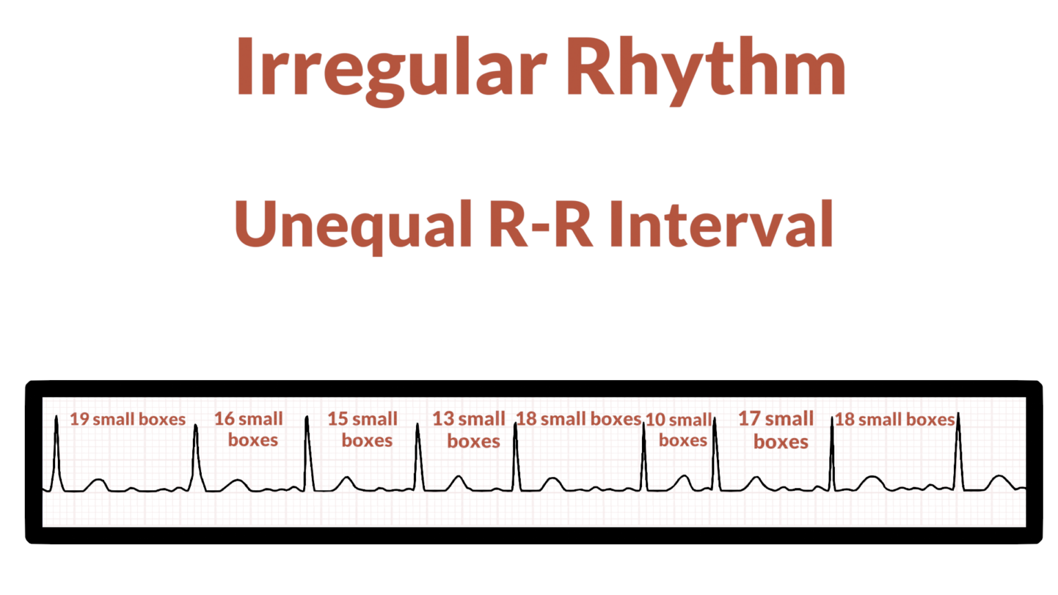 Interpreting ECG Strips – Nursing Unraveled
