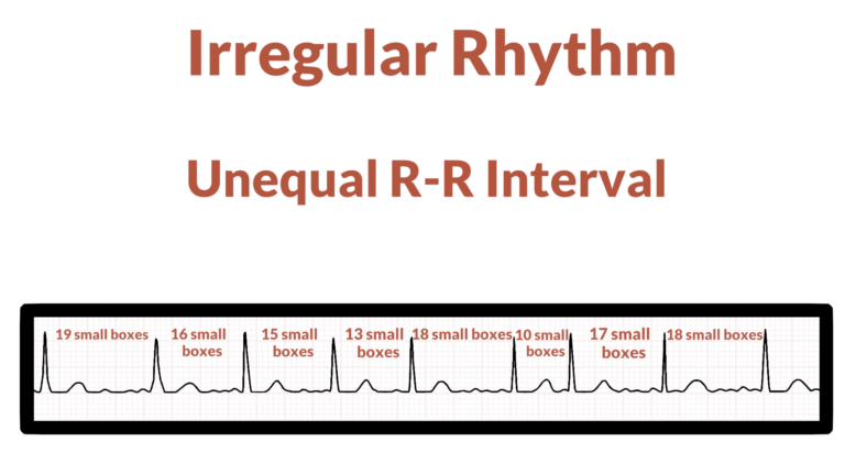 Interpreting ECG Strips – Nursing Unraveled
