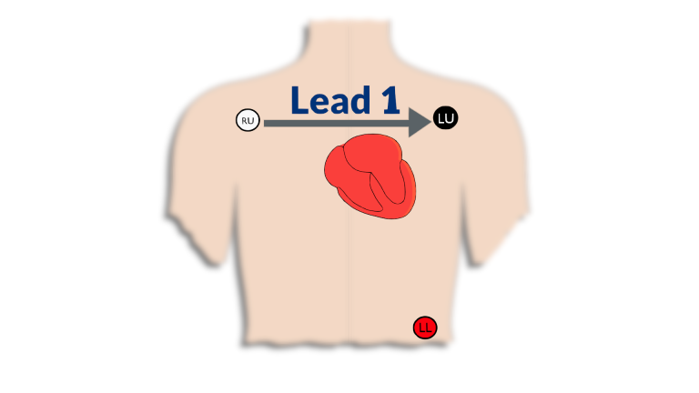3-Lead ECG – Nursing Unraveled