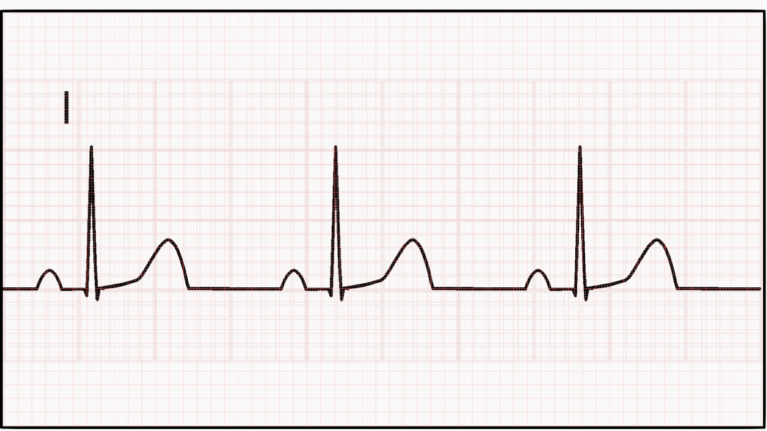 3-Lead ECG – Nursing Unraveled
