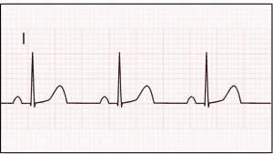 3-Lead ECG – Nursing Unraveled