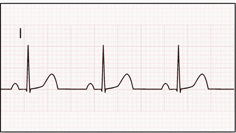 3-Lead ECG – Nursing Unraveled