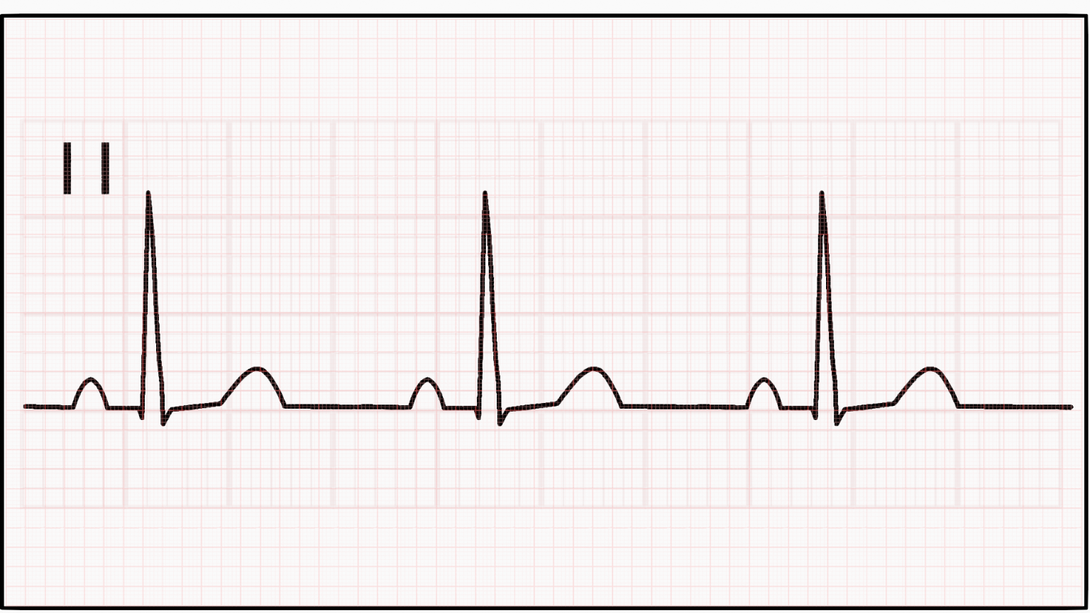 3-Lead ECG – Nursing Unraveled