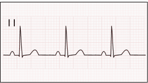 3-Lead ECG – Nursing Unraveled