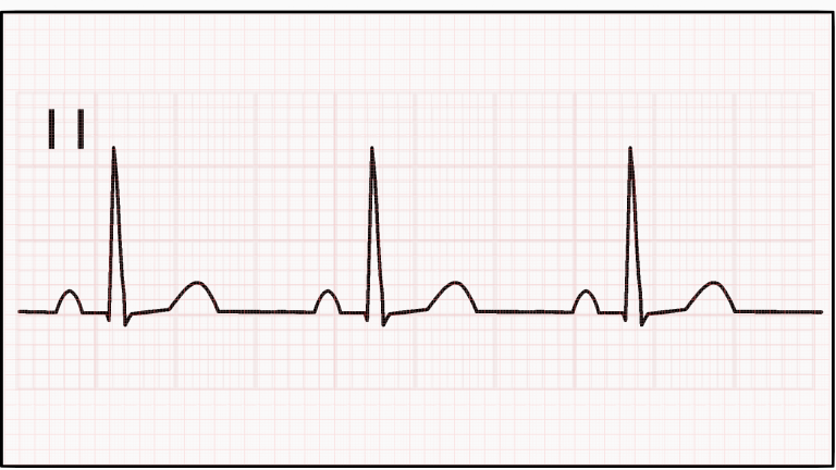 3-Lead ECG – Nursing Unraveled