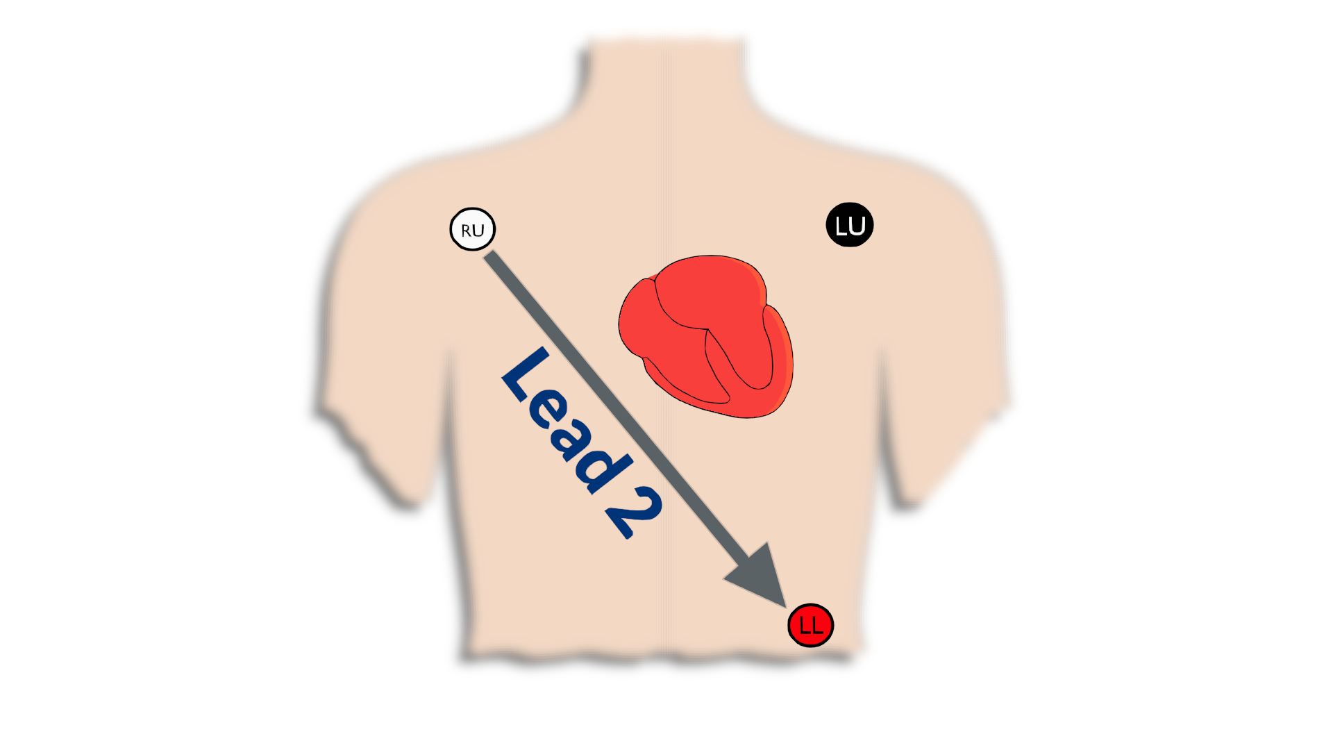 3-Lead ECG – Nursing Unraveled
