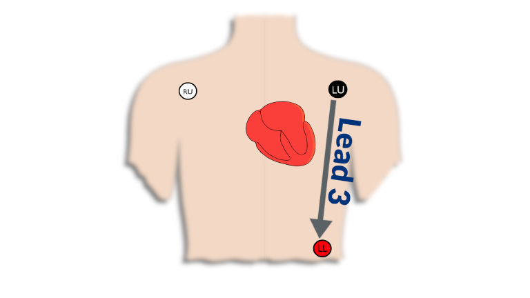 3-Lead ECG – Nursing Unraveled