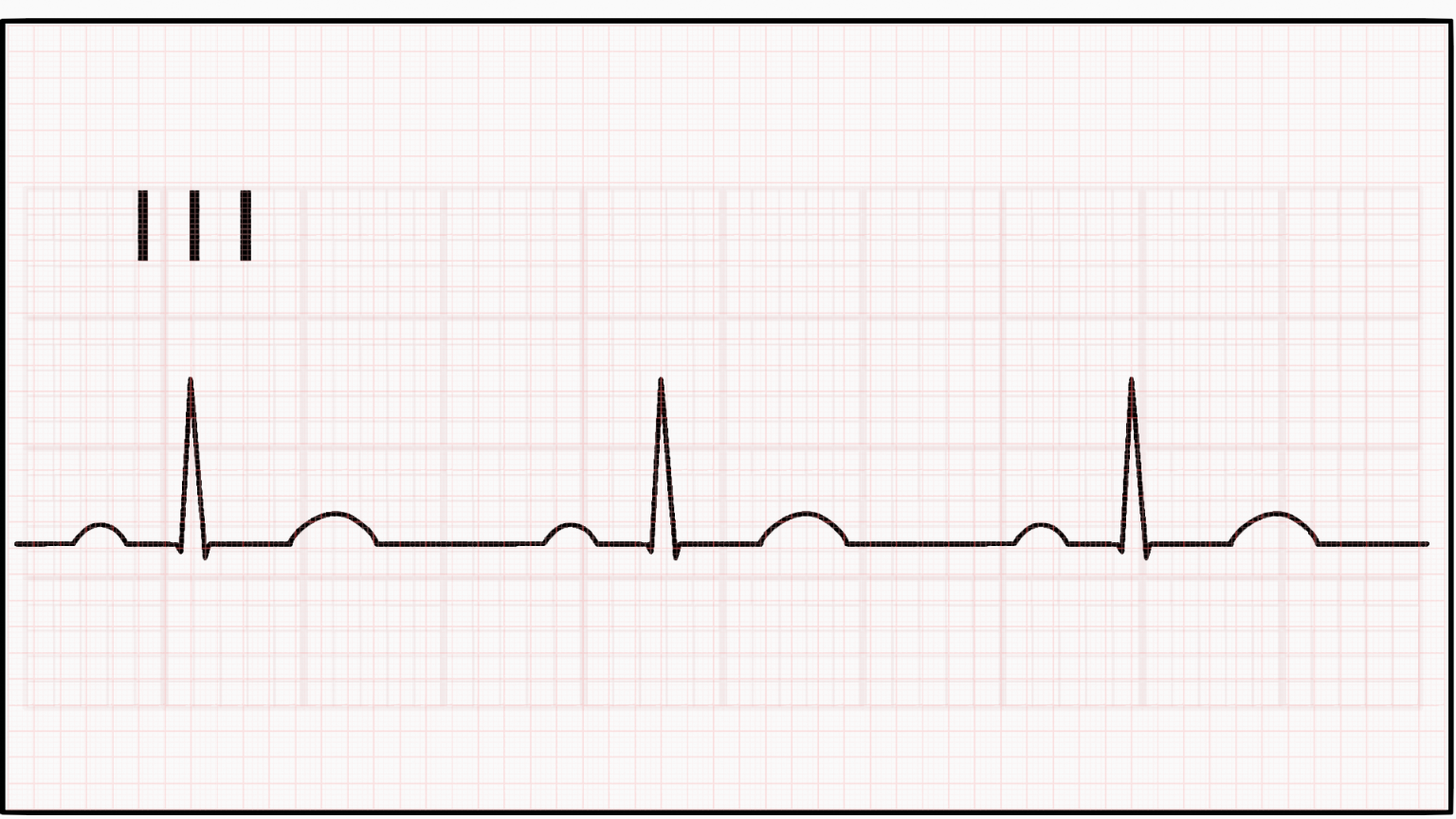 3-Lead ECG – Nursing Unraveled