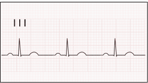 3-Lead ECG – Nursing Unraveled