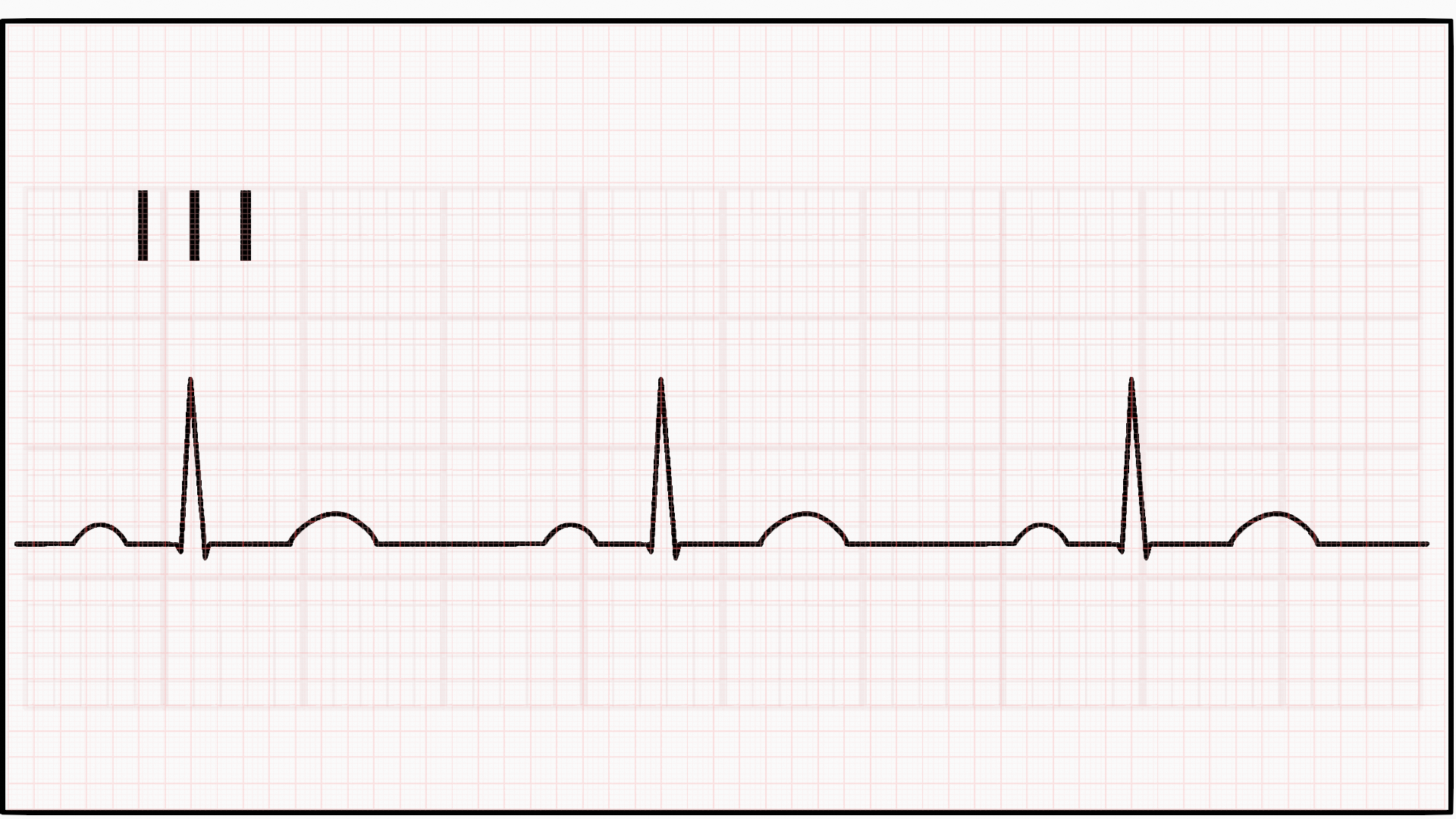 3-Lead ECG – Nursing Unraveled