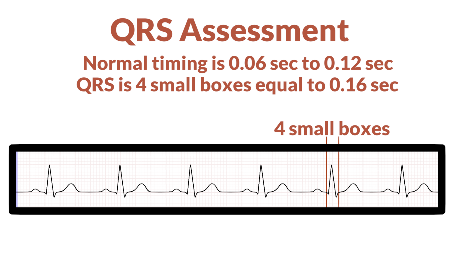 Interpreting ECG Strips – Nursing Unraveled