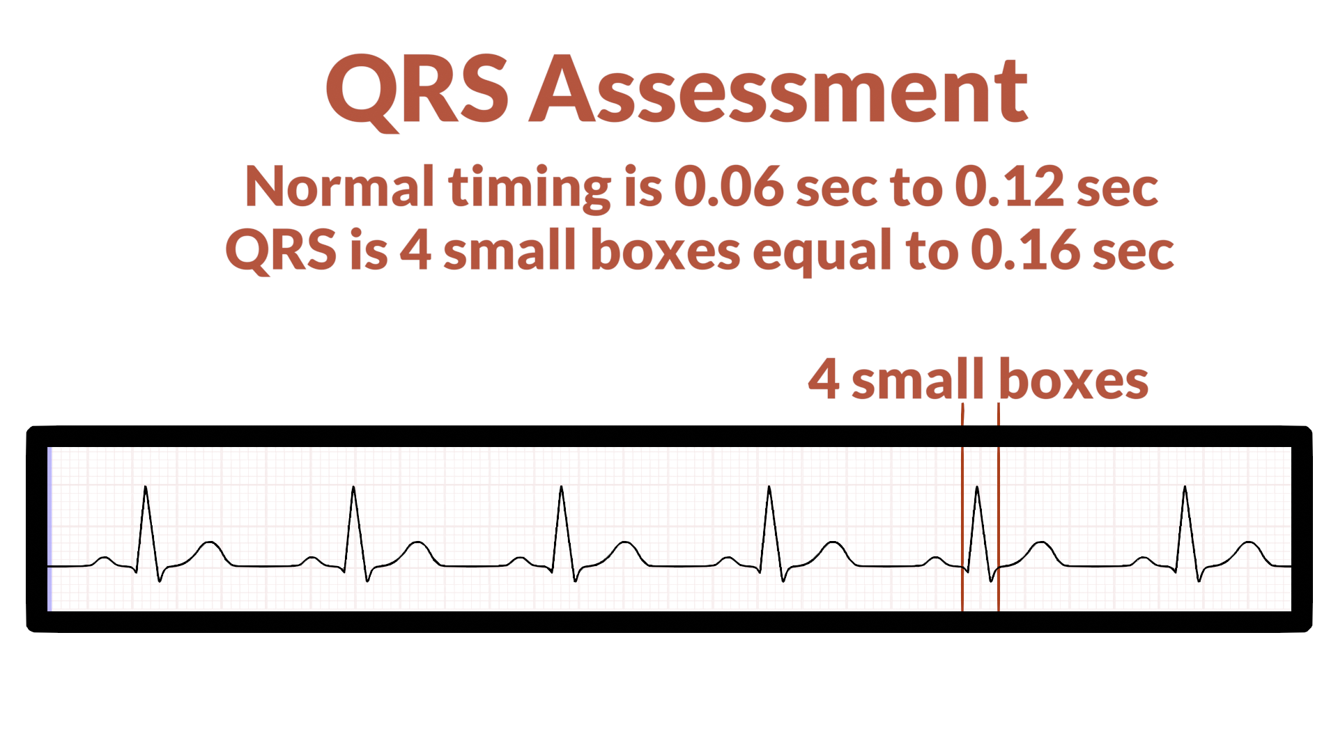 Interpreting ECG Strips – Nursing Unraveled