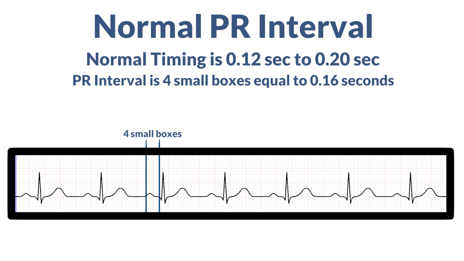 Interpreting ECG Strips – Nursing Unraveled