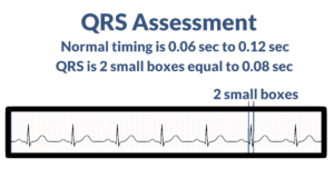 Interpreting ECG Strips – Nursing Unraveled