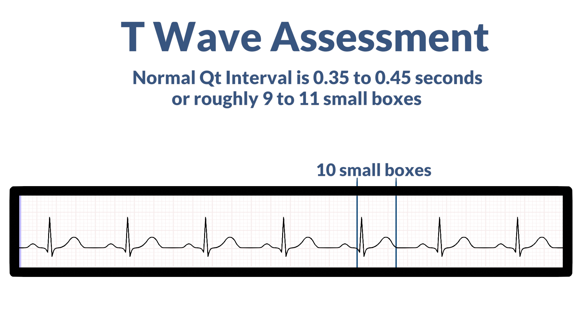 Interpreting ECG Strips – Nursing Unraveled