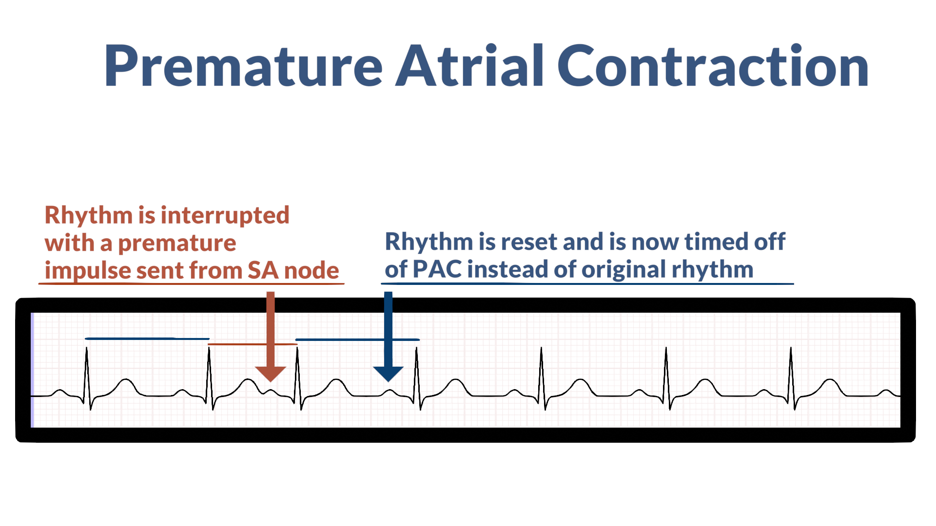 Interpreting ECG Strips – Nursing Unraveled