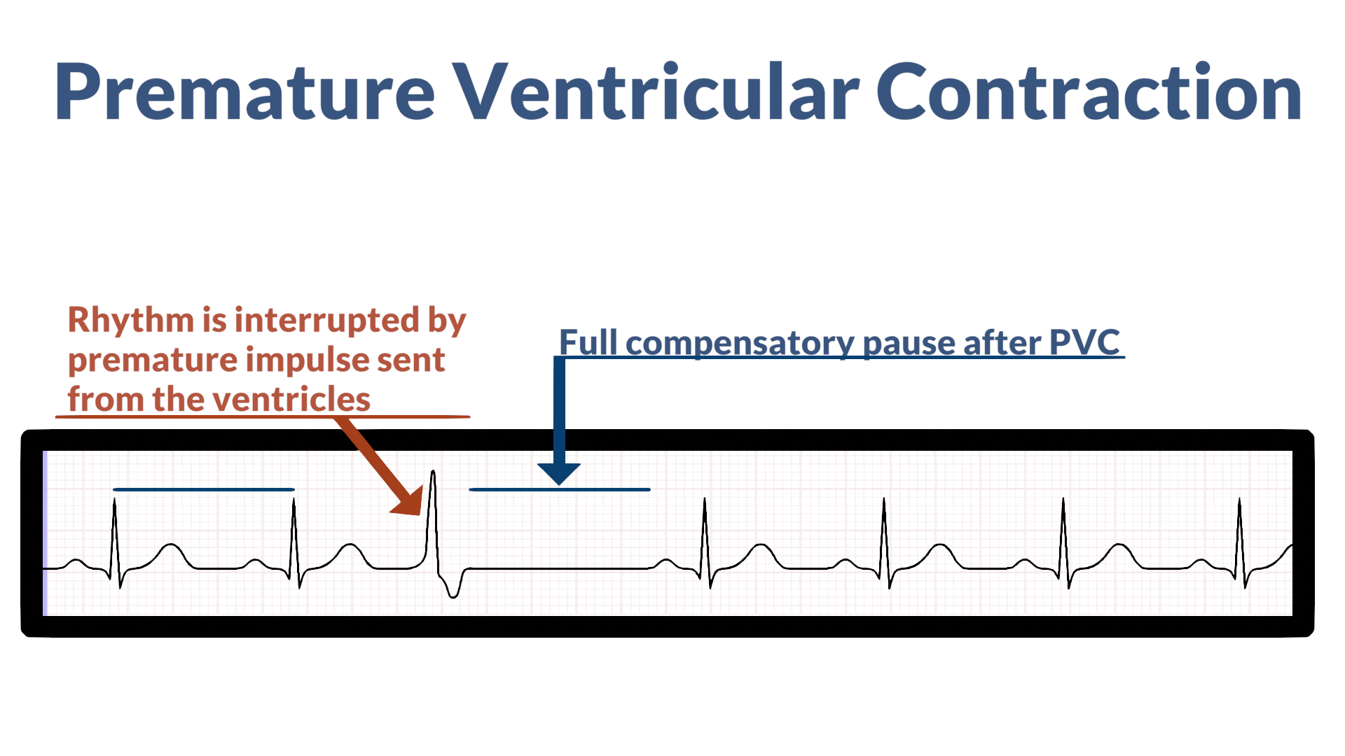Interpreting ECG Strips – Nursing Unraveled