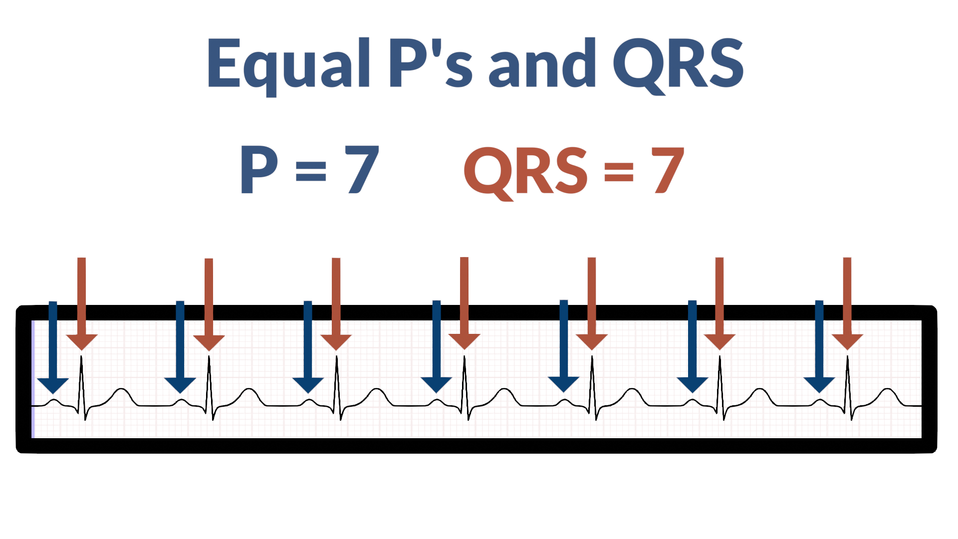 Interpreting ECG Strips – Nursing Unraveled