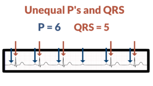 Interpreting ECG Strips – Nursing Unraveled