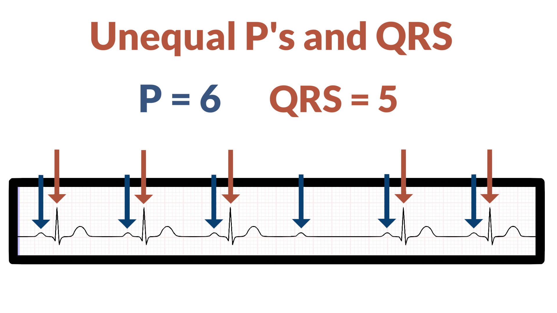 Interpreting ECG Strips – Nursing Unraveled