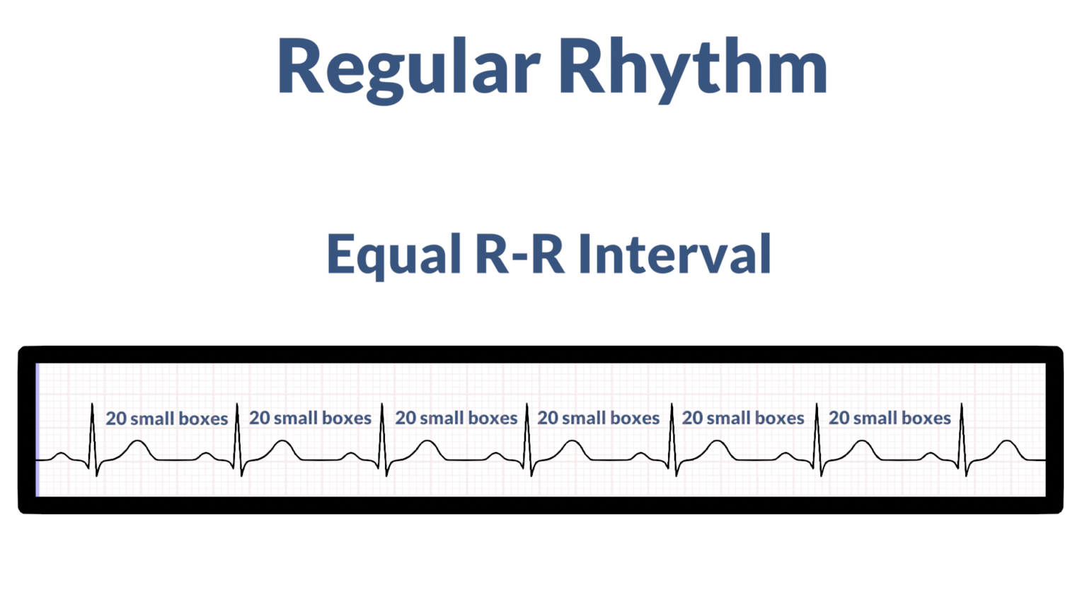 Interpreting ECG Strips – Nursing Unraveled