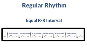 Interpreting ECG Strips – Nursing Unraveled