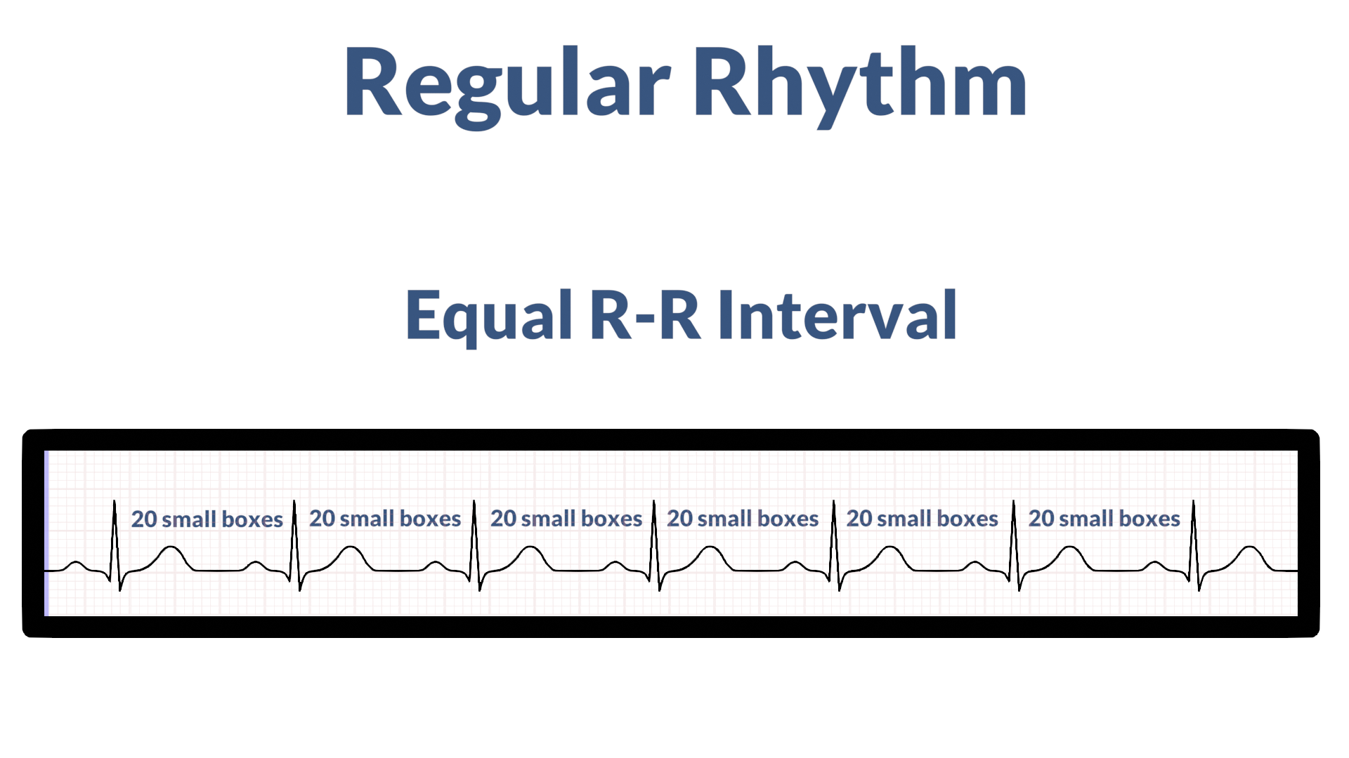 Interpreting ECG Strips – Nursing Unraveled