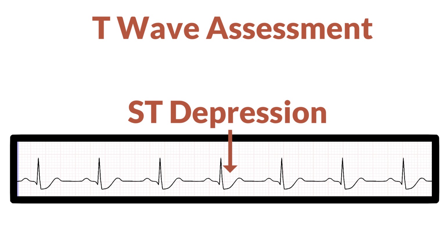 Interpreting ECG Strips – Nursing Unraveled