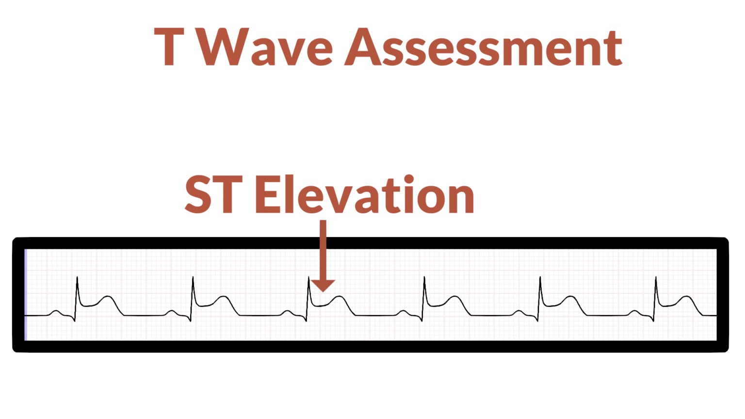 Interpreting ECG Strips – Nursing Unraveled