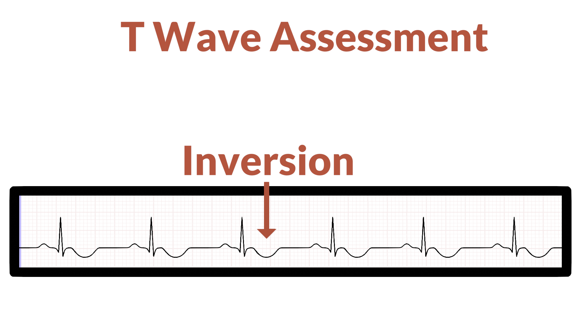Interpreting ECG Strips – Nursing Unraveled
