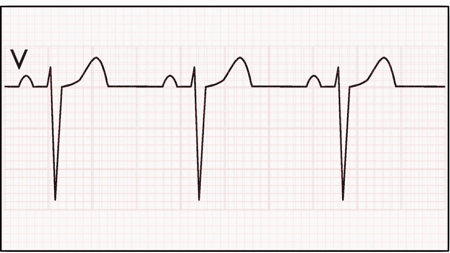 5-Lead ECG – Nursing Unraveled