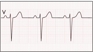 5-Lead ECG – Nursing Unraveled