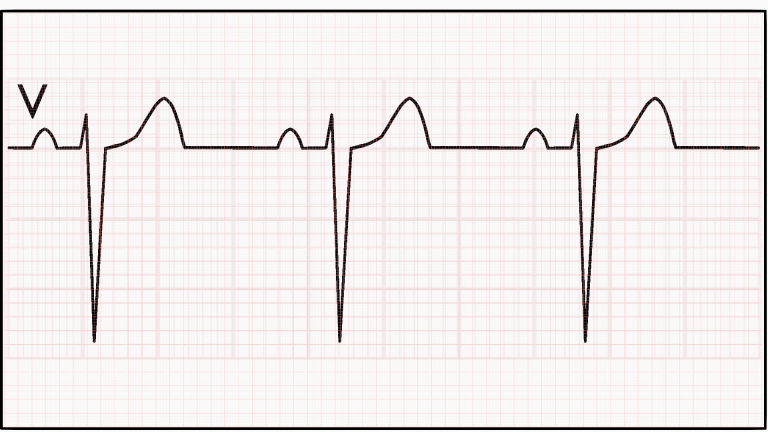 5-Lead ECG – Nursing Unraveled
