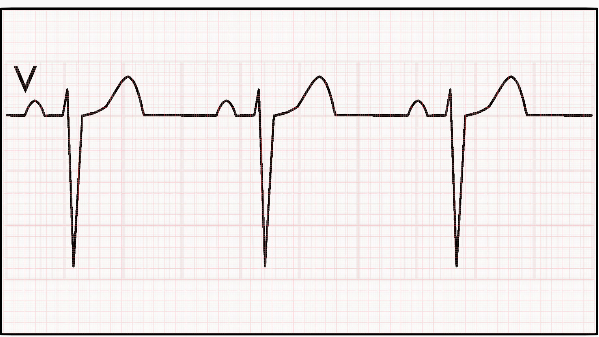 5-Lead ECG – Nursing Unraveled