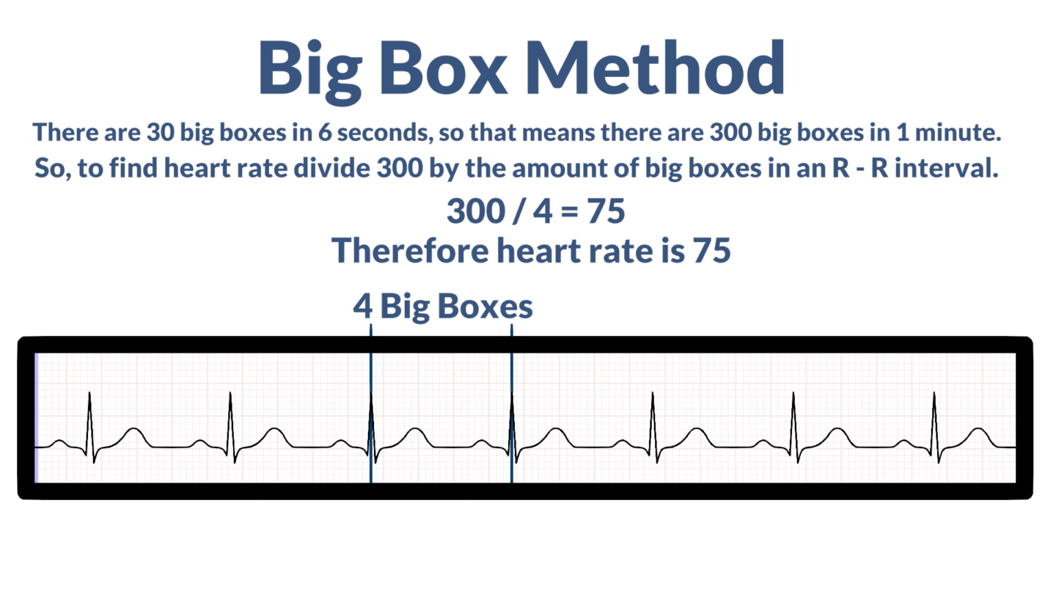 Interpreting ECG Strips – Nursing Unraveled