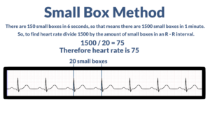 Interpreting ECG Strips – Nursing Unraveled