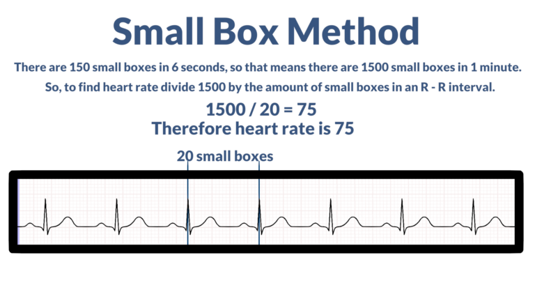 Interpreting ECG Strips – Nursing Unraveled