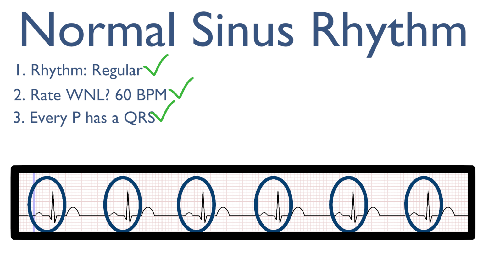 Normal Sinus Rhythm (NSR) – Nursing Unraveled