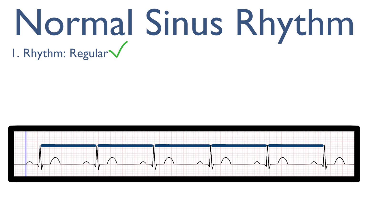 Normal Sinus Rhythm (NSR) – Nursing Unraveled