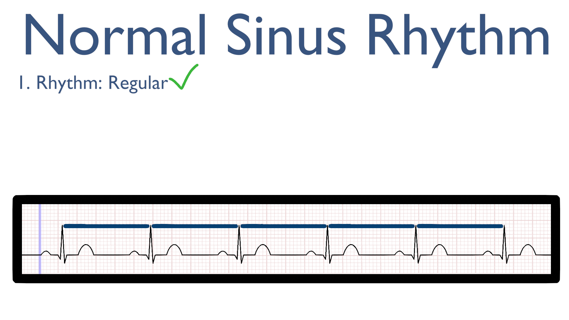 Normal Sinus Rhythm (NSR) – Nursing Unraveled
