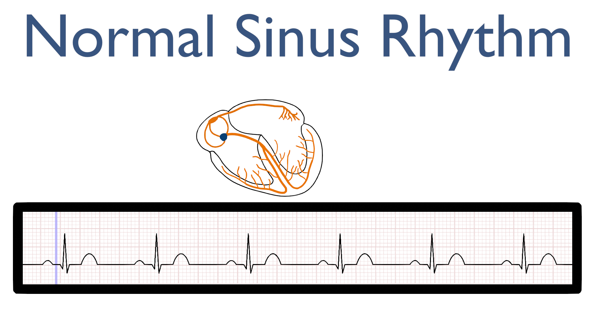 Normal Sinus Rhythm (NSR) – Nursing Unraveled